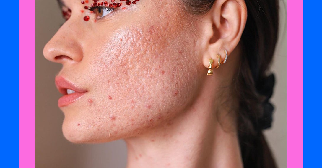 10 Skin Positivity Influencers To Follow ASAP