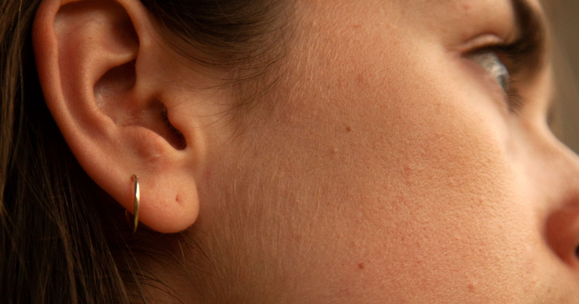 7 Facts About Cheek Filler: Cost, Pain, And Results