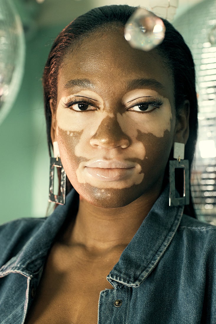 Vitiligo Makeup Commercial | Saubhaya Makeup