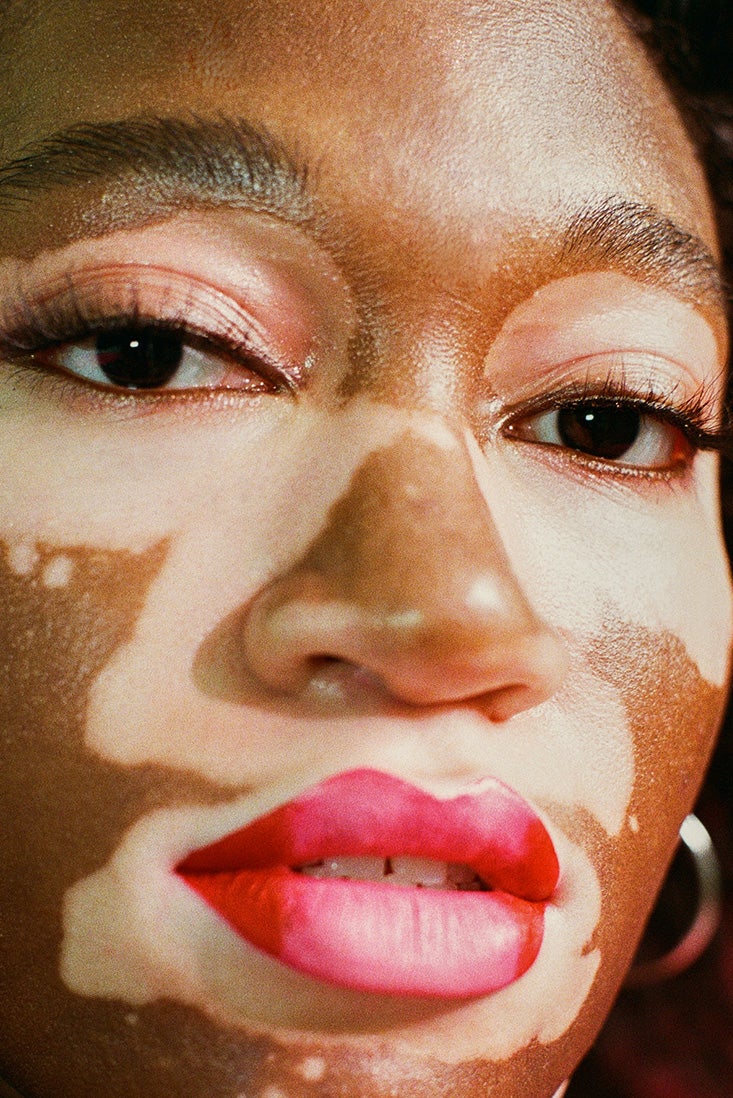 Vitiligo Makeup Commercial | Saubhaya Makeup