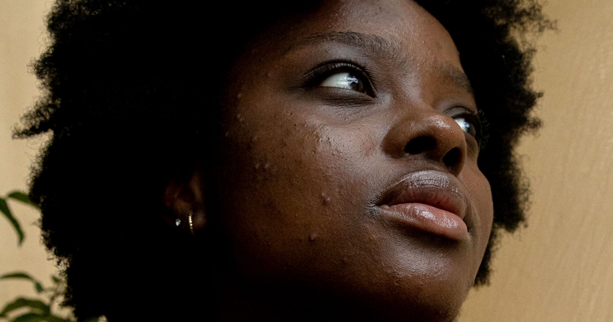 Rosacea In Dark Skin Symptoms Expert Advice